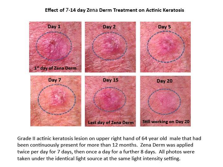 Effective Actinic Keratosis Treatment With No Visible Side Effects